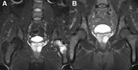 Signal Intensity Changes Consistent With Hyperintense Bone Marrow Edema Download Scientific