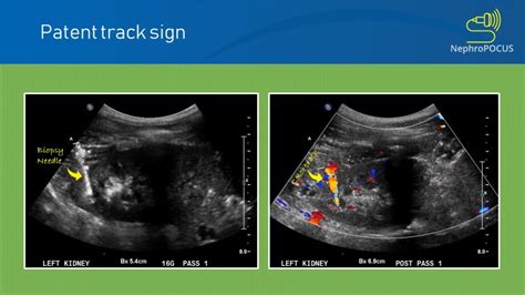 Post Biopsy Bleeding Nephropocus