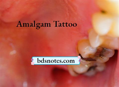 Amalgam Tattoo Bds Notes