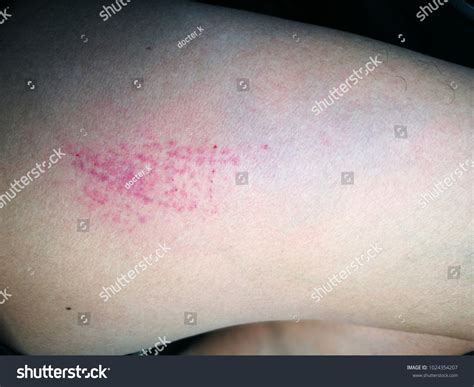 Skin Disease Lesion Ecchymosis Vasculitis Nursing Foto De Stock