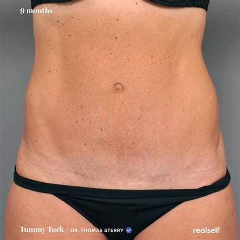 Pin On Body Contouring Procedures