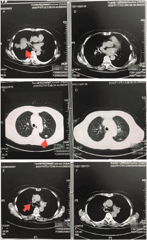 The Pulmonary Computed Tomography Ct Of Different Time Showed Mass