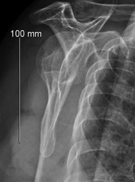 Humerus Greater Tuberosity Fracture X Ray At Evelyn Lawson Blog