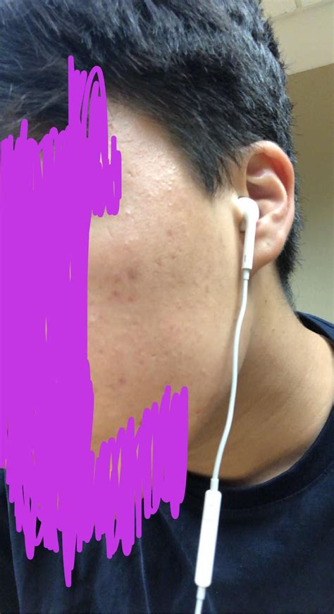 Sudden Itchy Rash With Small Pimples Developed After Wearing A Face