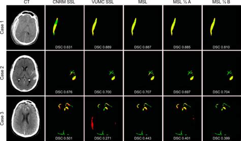 Distributed Deep Learning Across Multisite Datasets For Generalized CT Hemorrhage Segmentation