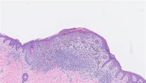 Skin Cancer Biopsy Can You Trust The Results Right As Rain By Uw
