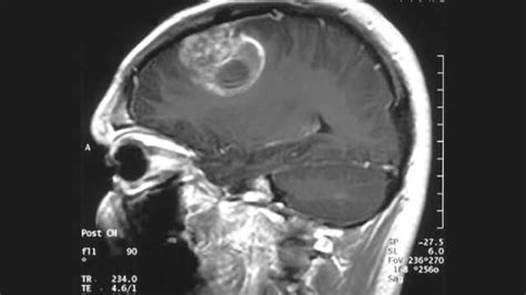 Depriving Deadly Brain Tumors Of Cholesterol May Be Their Achilles