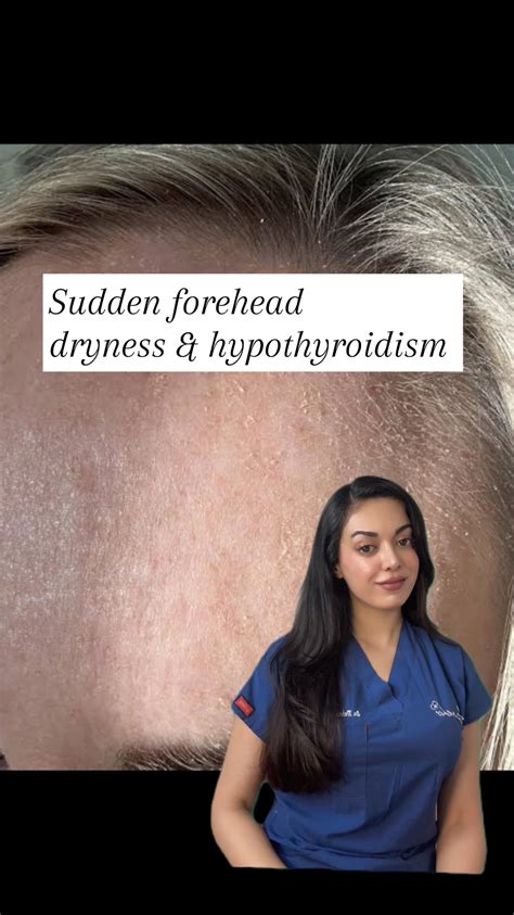Drmehss Scleroderma Is An Autoimmune Disease Causing Skin Hardening