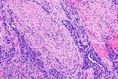 Muscularis Propria Invasion In The Urinary Bladder Libre Pathology