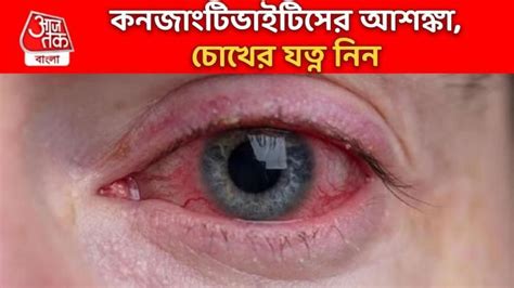 Conjunctivitis Reason কনজাংটিভাইটিস থেকে কীভাবে বাঁচবেন রইল উপায় Aaj Tak Bangla