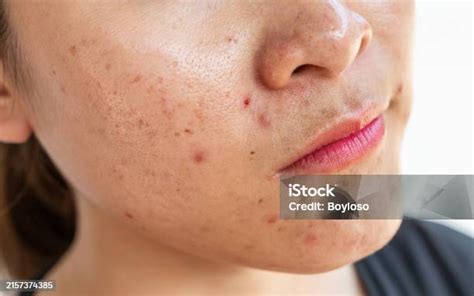 얼굴에 여드름 흉터 주름과 같은 피부 문제가 있는 아시아 여성의 크롭 샷 보기 30 34세에 대한 스톡 사진 및 기타 이미지 30 34세 걱정하는 긁음 Istock