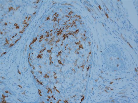Cutaneous Lymphadenoma A Case Report And Literature Review Ccid