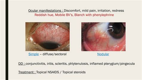 Episcleritis And Scleritis Causes Clinical Features Treatmentpptx