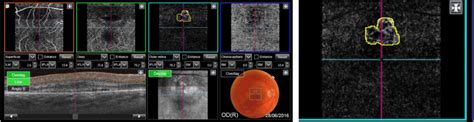 Example Of Images Analysed A Image Of Oct A Showing Cnvm And B Image