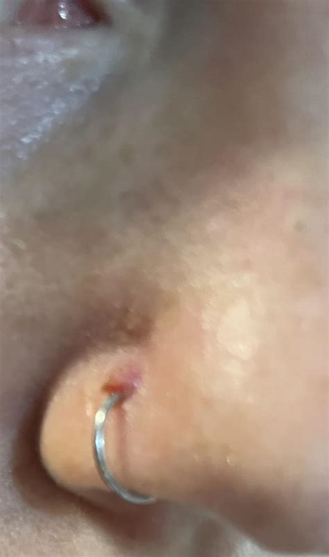 Nose Keloid Rkeloids
