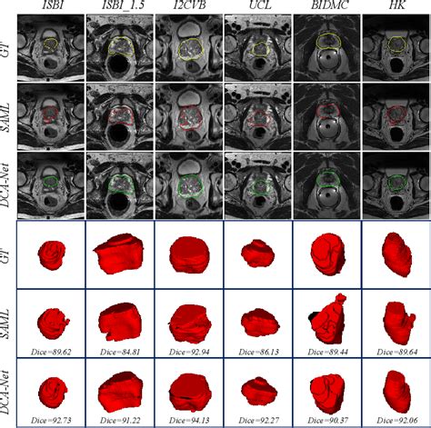 Domain Composition And Attention For Unseen Domain Generalizable Medical Image Segmentation