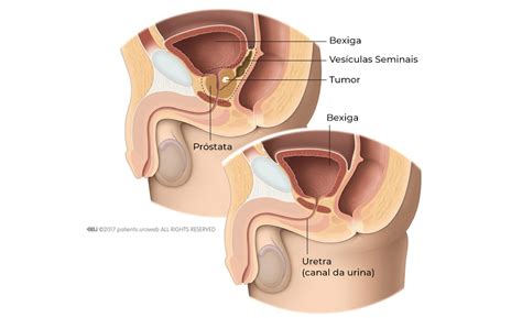 Figura Prostatectomia Radical Urobh Urologia Minimamente Invasiva