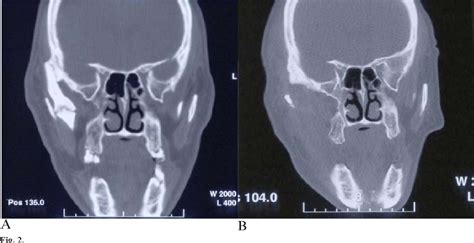 Figure 2 From Myositis Ossificans Of The Temporalis Muscle Case Report