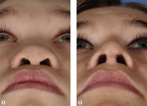 Controlling The Nostril Size Ento Key