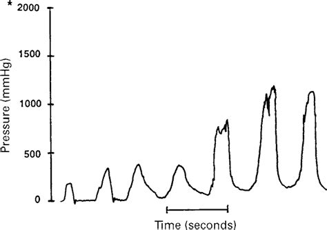 Output Of Pressure Transducer During Finger Packing Showing Pressure Download Scientific