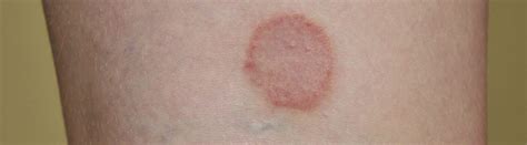 Ringworm Symptoms Causes Medikoph