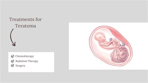 Teratoma Treatment Cost In India Medsurge India