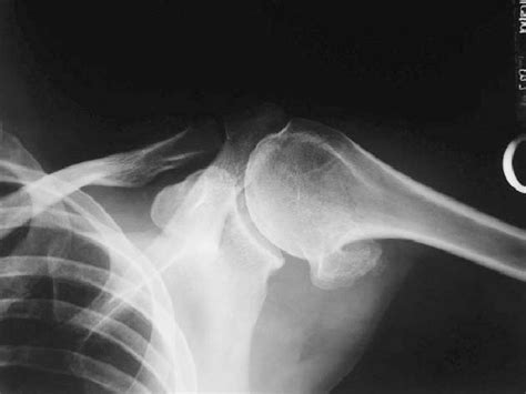 Humerus X Ray