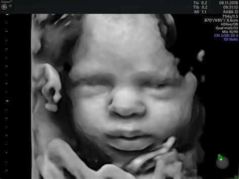 Pregnancy Scans — Galway Ultrasound Specialists
