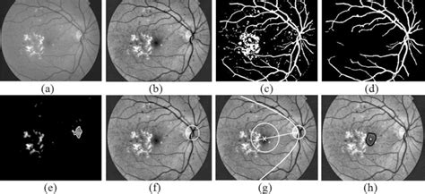 Decision Support System For The Detection And Grading Of Hard Exudates