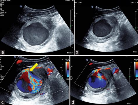 A Rare Case Of Acute Traumatic Complicated Right Axillary Artery