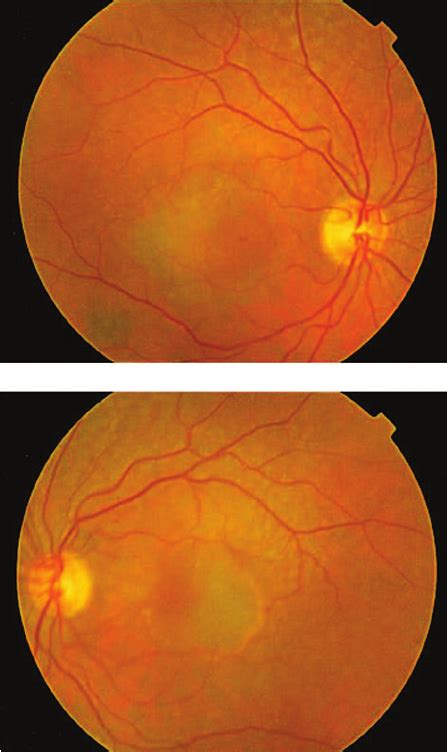 Color Fundus Photographs Of The Right And Left Eyes Download