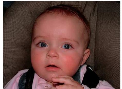 9 The Clinical Presentation Of Left Sided Ectopic Pupil Is