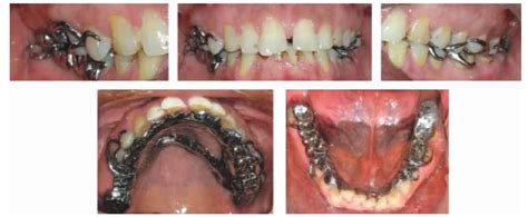 A Permanent Solution To Restore Occlusal Vertical Dimension And Partial