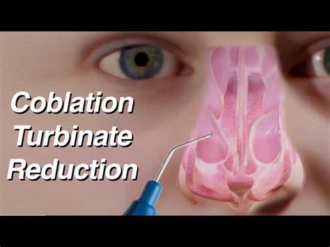 Nasal Turbinate Reduction Nasal Congestion Las Vegas Nv Ph