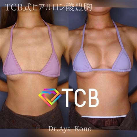 ヒアルロン酸豊胸 フォトセレクション（ドクター別ヒアルロン酸豊胸症例） 美容整形なら東京中央美容外科【tcb公式】