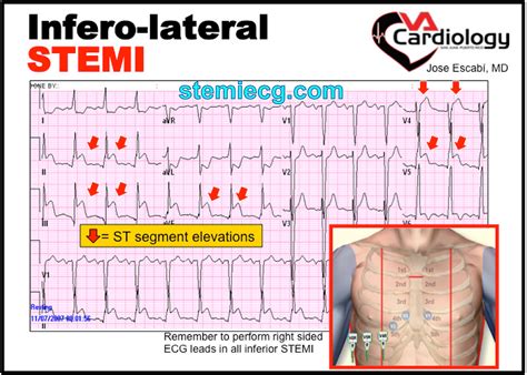 Mastering Stemi Ecg