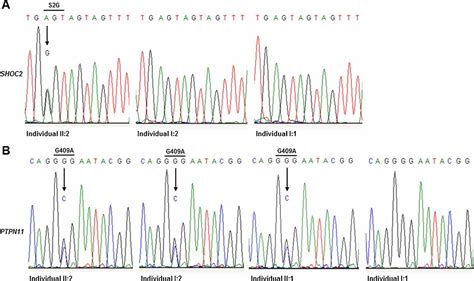 Co‐occurring Shoc2 And Ptpn11 Mutations In A Patient With Severe