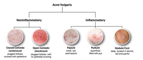 Derm Acne Flashcards Quizlet