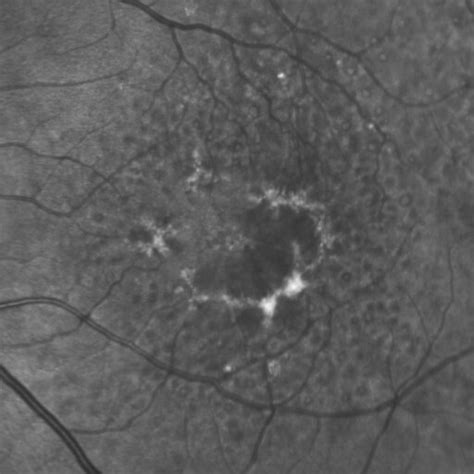 examples of ga top and rpd bottom segmentations from different