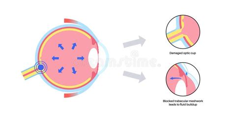 Glaucoma Eye Disease Stock Vector Illustration Of Hypertension 332624559