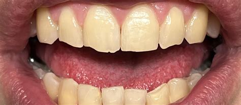 Ipr Question R Invisalign