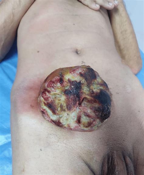 Dermatofibrosarcoma Protuberans Dfsp A Type Of Low Grade Soft Tissue