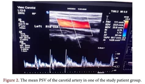Wntsignalling Vascularcalcification Hemodialysis Scientific