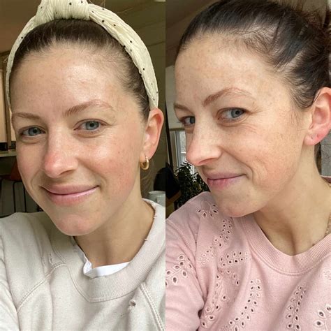 Olay Retinol 24 Before And After Pictures