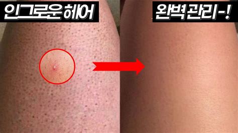 다리털 겨털 인그로운 헤어 해결하는 새로운 방법 없애기 셀프 관리 제모 스크럽 Youtube