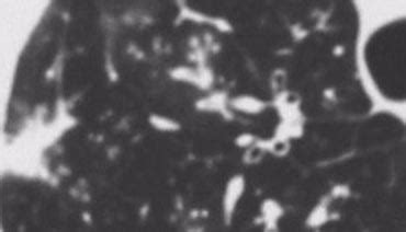 The Radiology Assistant HRCT Basic Interpretation