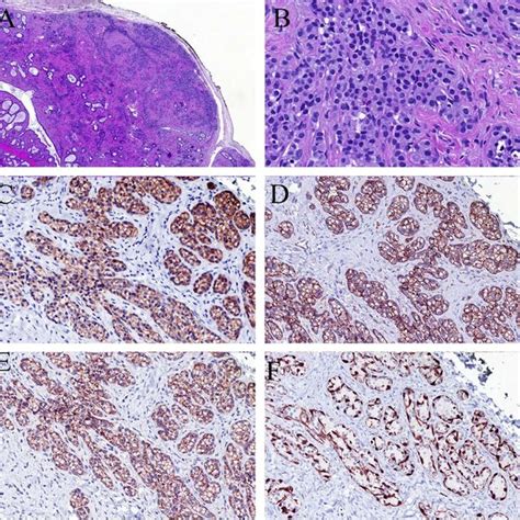 Ln With Aberrant Membranous E Cadherin Complex Protein Expression Download Scientific Diagram