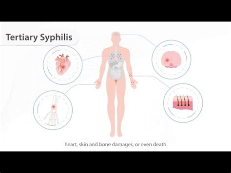 Syphilis A Curable Sexually Transmitted Disease Youtube