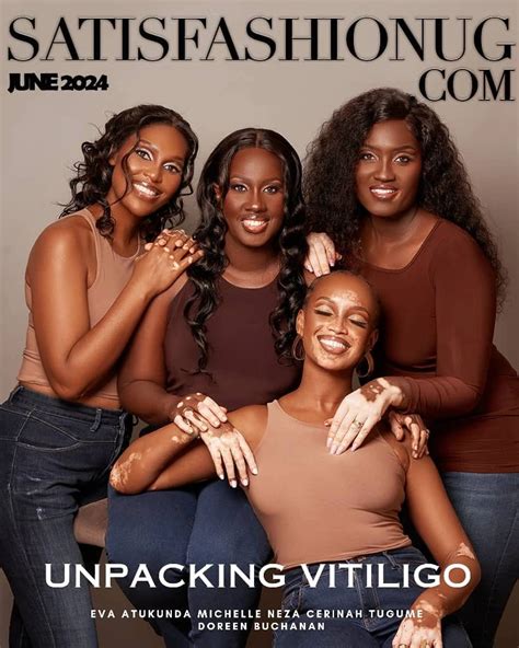 Nsimenta Noela On Linkedin Vitiligoawareness