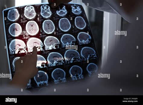 Doctors Examining MRI Images Of Patient With Multiple Sclerosis In